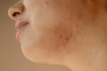 Why neck pimples happen and how to get rid of them – Cactus Skincare